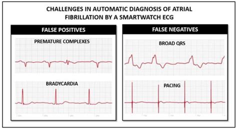 Atrial Fibrillation Detection With Smart Watches Curamorbus