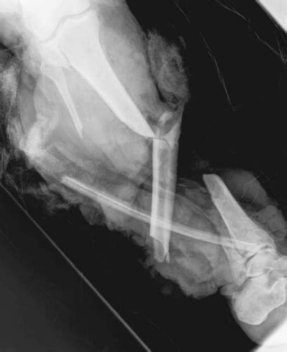 Skeletal 1 Fracture Classification Flashcards Quizlet