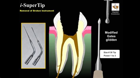 Removal Of Broken Instrument Youtube