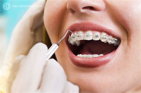 A Look At Discreet Orthodontic Treatment Options