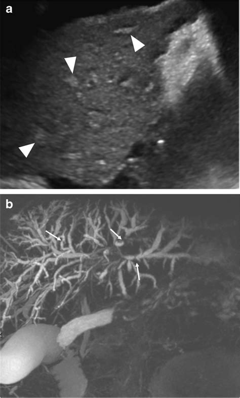 An 18 Year Old Woman With Primary Sclerosing Cholangitis Autoimmune