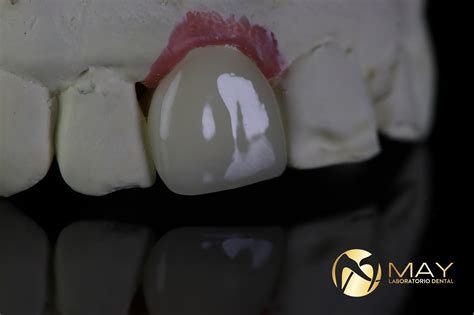 Lithium Disilicate Wissden