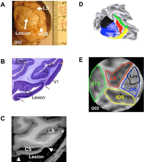 Characterization Of The V1 Lesion A Picture Of Macaque Q02s Brain Download Scientific Diagram