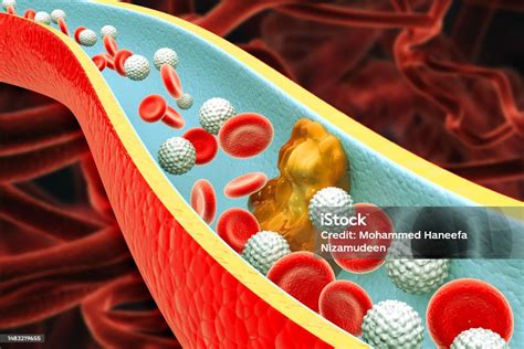죽상 동맥 경화증 뇌졸중 혈관에 혈전이 있습니다 3d 그림 3차원 형태에 대한 스톡 사진 및 기타 이미지 3차원 형태 건강