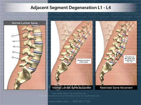 Adjacent Segment Degeneration L1 L4 Trialquest Inc