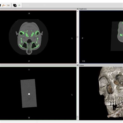 How To 3d Print A Dicom File Step By Step Tutorial Medimodel