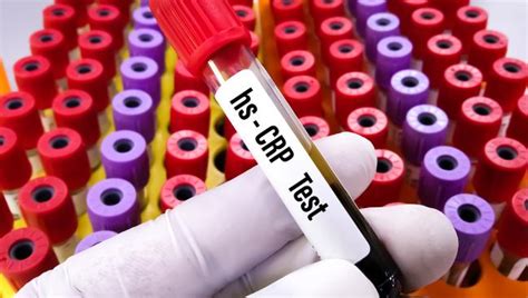 Inflammation More Powerful Than Ldl As Cv Risk Predictor In Statin Free Patients