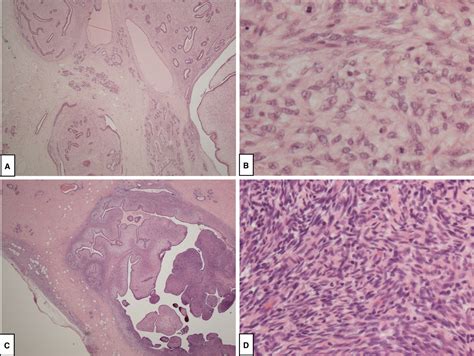 Diagnostic Concordance Of Phyllodes Tumour Of The Breast Rakha 2021 Histopathology Wiley