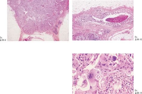 The Evolution Of Casting Type Calcifications Oncohema Key