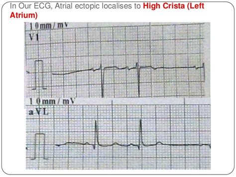 Ecg Atrial Bigeminy