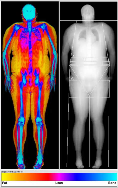 DEXA Scan Services MeasureUp Body Composition Analysis