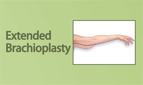 Extended Brachioplasty