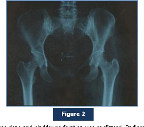 Figure 1 From Bladder Perforation With Intrauterine Contraceptive Device Semantic Scholar