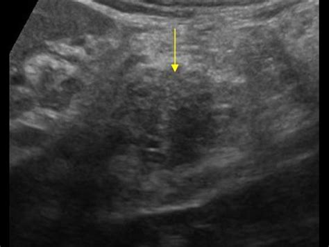 Abdomen And Retroperitoneum 13 Pancreas Case 131 Pancreatic Head