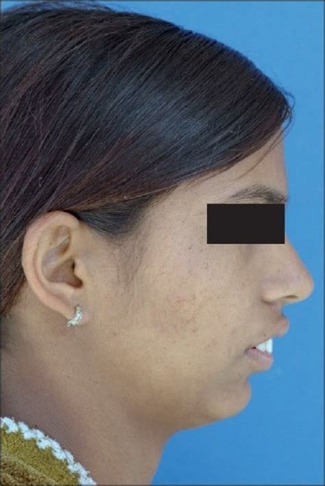 Pretreatment Profile View Showing Class Ii Skeletal Pattern Download