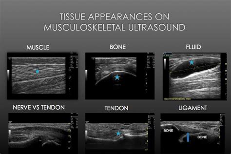 Common Extensor Tendon Tear The Ultrasound Site