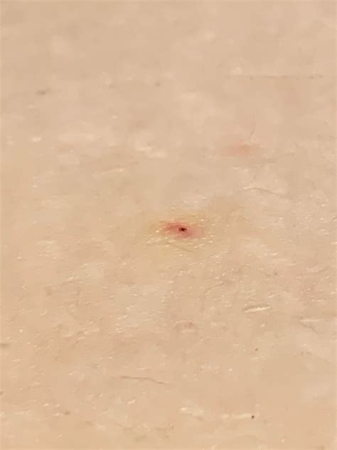 Compression Lows After Inserting A New Sensor Even Though Im Not Laying On My Dexcom At All Is