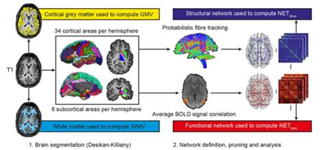 The Model Of Brain Neurodegeneration Based On Plykin Newhouse Attractor With Sinusoidal Force