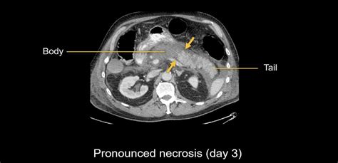 Necrotic Pancreatitis Ct Scan