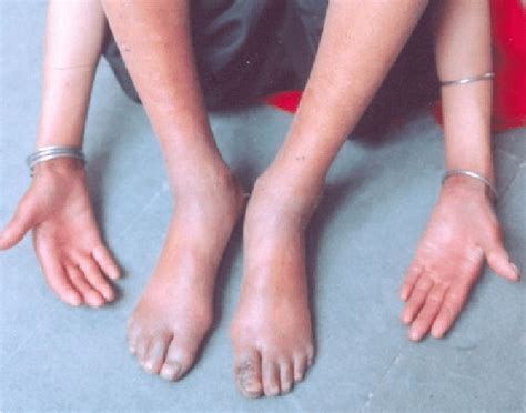Diffuse Palmer Keratoderma With Arachnodactyly Of Hands And Feet Download Scientific Diagram