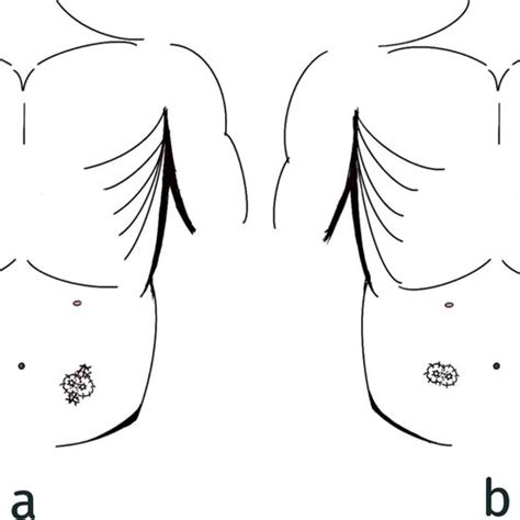 The Site Of Temporary Ileostomy A Sses B Sns Sses Stoma Through The Download Scientific