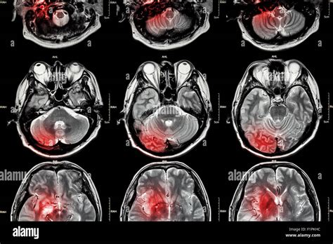 Film Mri Magnetic Resonance Imaging Of Brain This Mri Of Brain Is