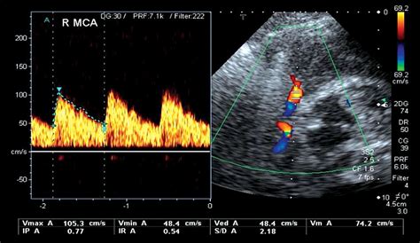 Use Of Transcranial Doppler Ultrasonography In The Pediatric Intensive Care Unit Consultant