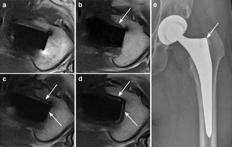 Prospective And Longitudinal Evolution Of Postoperative Periprosthetic Findings On Metal
