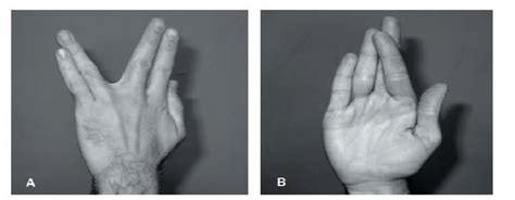 Mcp Abduction A And Adduction B [18] Download Scientific Diagram