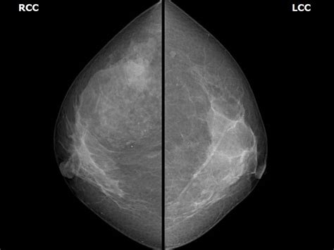 Atlas Of Breast Cancer Early Detection