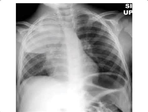 Discrete Nodule S With Volume Loss Or Retraction One Or More Nodular Download Scientific