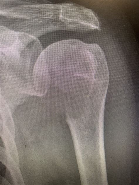 Common Extensor Tendon Tear The Ultrasound Site