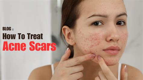 How To Treat Acne Scars