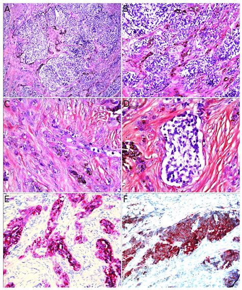Melanotic Neuroectodermal Tumor Of Infancy A Nests Of Small Round Download Scientific