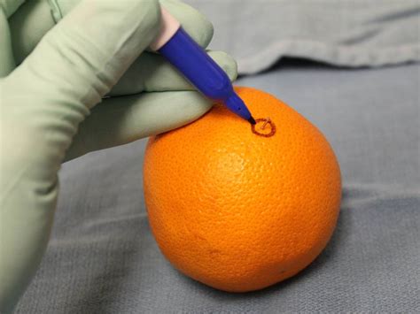 How Is A Scalp Biopsy Performed — Donovan Hair Clinic