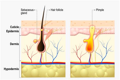 Medical Treatment For Pimples And Pimple Scars EMediHealth