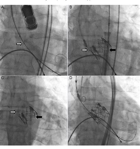 Figure 1 From Subacute Retrograde Tavi Migration Successfully Treated