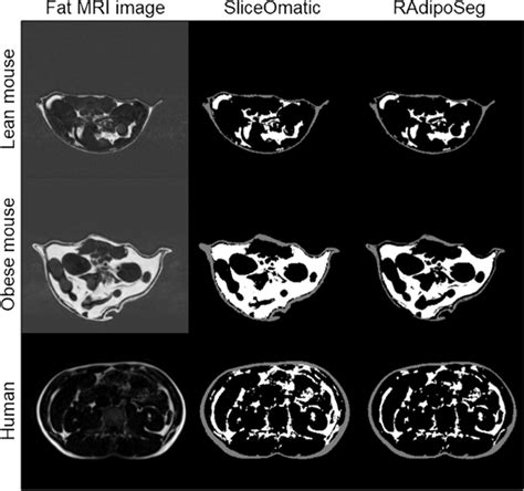 Comparison Of Fat Segmentation By Sliceomatic And Radiposeg One Download Scientific Diagram