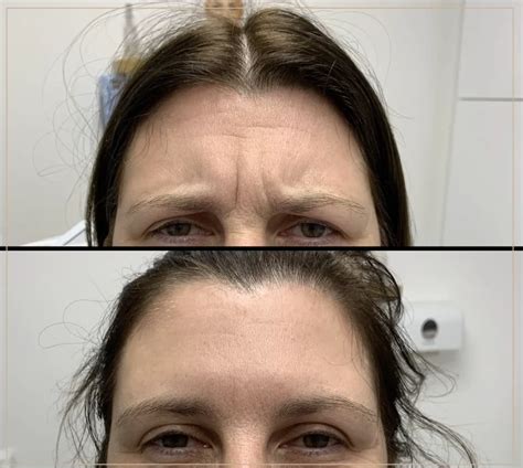 Botox Injection Sites Face Everything You Need To Know Aesthetics By Stephanie Livingston