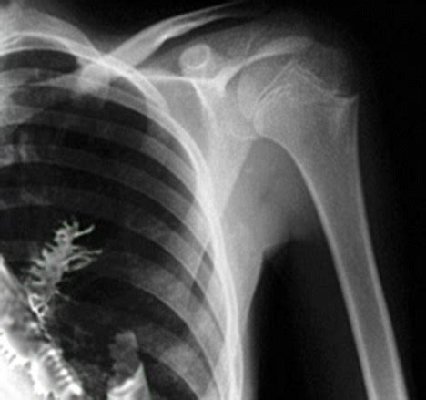 MEDIFACTS Tree Growing In The Lung