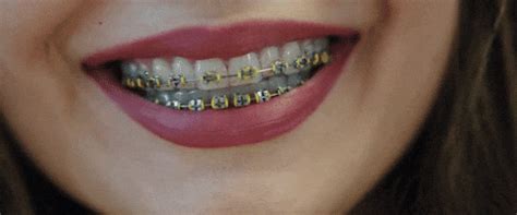 13 Main Things You Need To Know About Getting Braces In Singapore