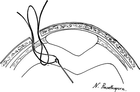 The Suture End Of The Second Loop Is Drawn Through The First Loop And