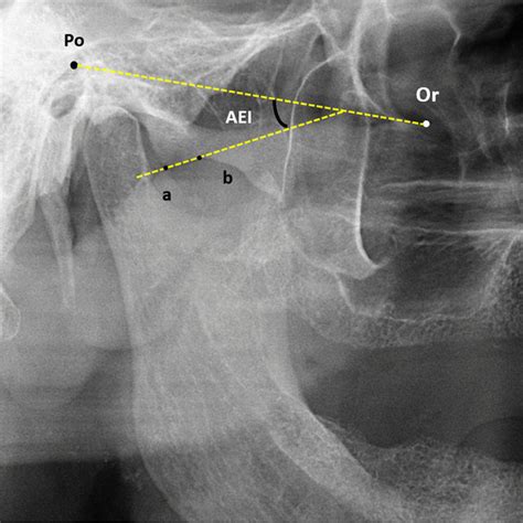Panoramic Morphometric Indices Measurement A Mandibular Cortical Download Scientific Diagram