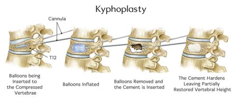 Kyphoplasty Treatment For Spinal Compression Fractures Your Health