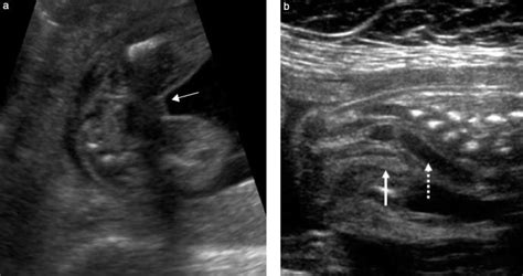 Ambiguous Genitalia Ultrasound Ambiguous Genitalia Ultrasound