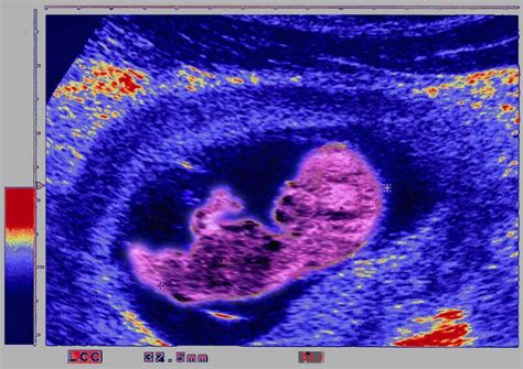 Here Is How Ai Is Being Used In Fetal Ultrasounds The Artificial Intelligence Ai Hub™