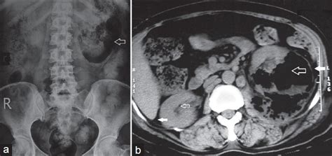 Pyelonephritis X Ray