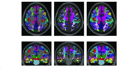 Comparison Of Cortex Parcellation With The Destrieux Atlas Gray