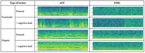 Spectrogram Helps To Differentiate Functional Tremor From Organic Mds Abstracts