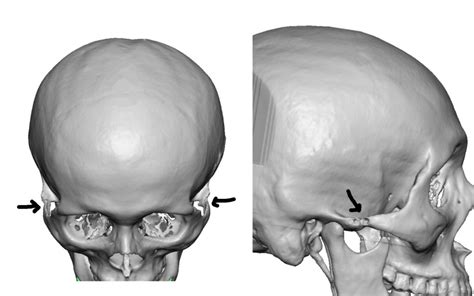 The Posterior Zygomatic Arch Osteotomy In Cheekbone Reduction Facial
